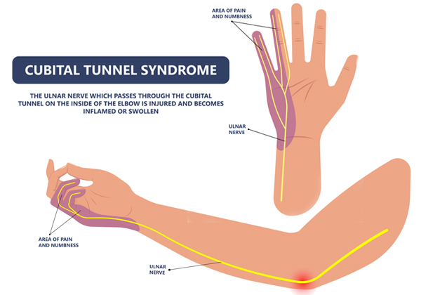 Cubital Tunnel Syndrome Causes Symptoms Diagnosis Treatment How