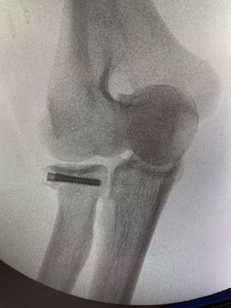 Recovery Time for a Fractured Elbow - Dr. Jagwant Singh