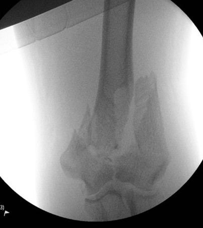 Recovery Time for a Fractured Elbow - Dr. Jagwant Singh